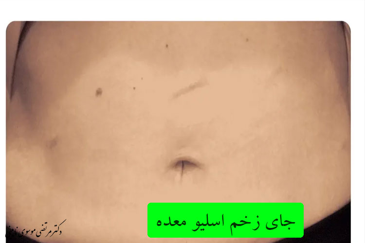 جای بخیه عمل اسلیو معده دکتر سید مرتضی موسوی